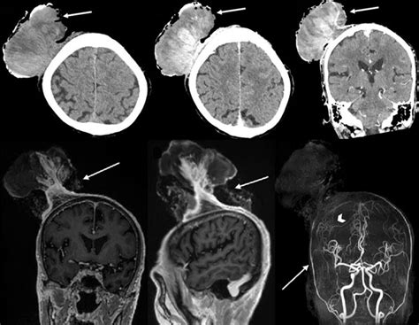 Primary Epithelioid Sarcoma Manifesting As A Fungating Scalp Mass