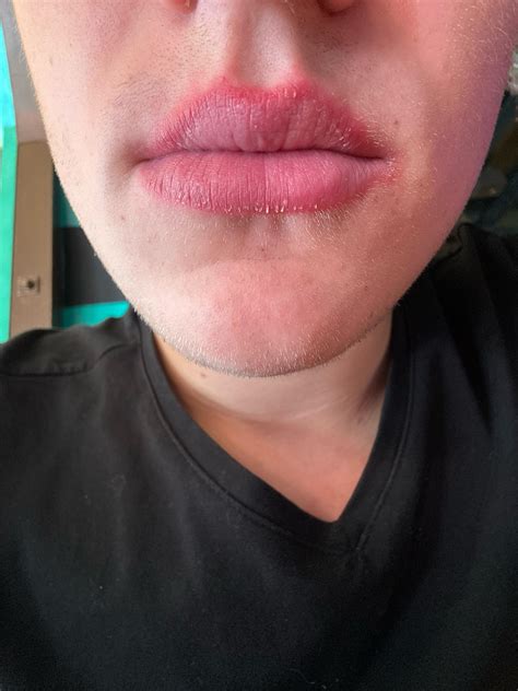 Red Dry Irritated Edge Around Lips Rmedicaladvice