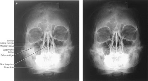 Facial Bones Radiology Key