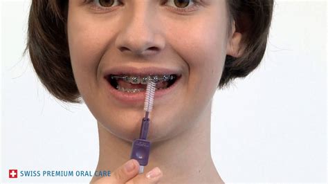 Interdental Brushing With Braces Youtube