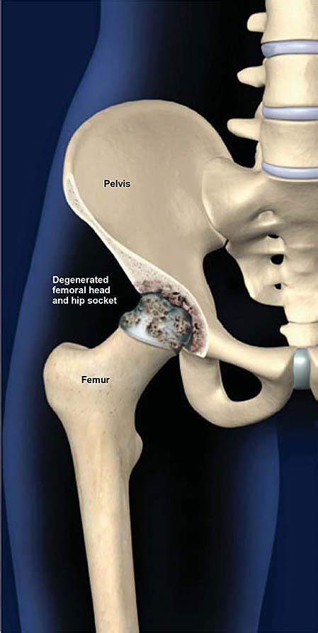Severe Degenerative Joint Disease Hip Joint Disease Degenerative