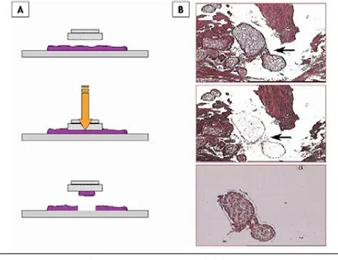 Laser Capture Microdissection Precision In Cellular Analysis