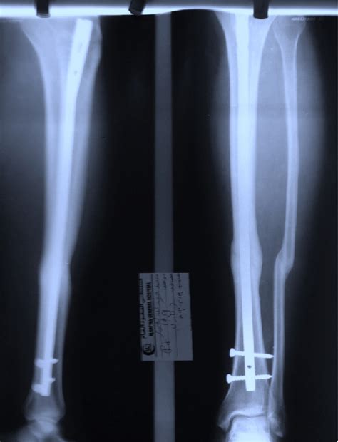 D Open Fracture Of The Tibia Type II With Primary Closure And Download Scientific Diagram