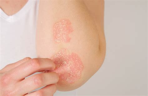 Psoriasis And Other Papulosquamous Disease Dermatology Australasia