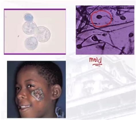 Systemic Mycosesprimary Mycoses Flashcards Quizlet