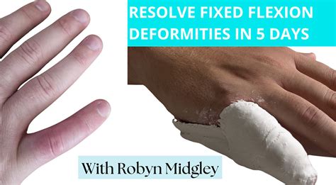 Correct Fixed Flexion Deformities In 5 Days Podcast Guide