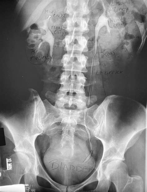 Pin By Dr Vicki Shaver On Urinary System Radiology Medical