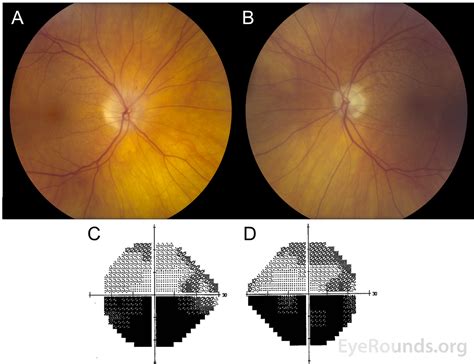 Successive Presentation Of Arteritic And Non Arteritic Anterior Ischemic Optic Neuropathy