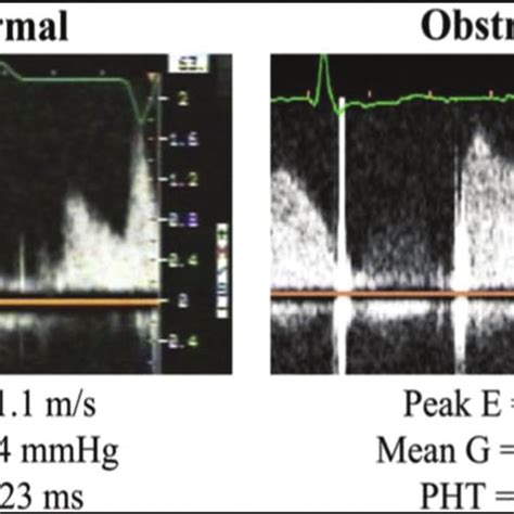 Cw Doppler Across Aortic Valve Showing High Mean Gradient Across Aortic