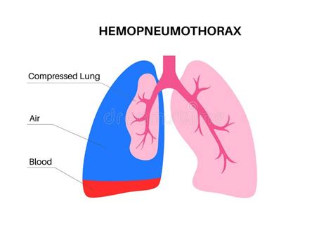 Hemopneumothorax Medical Poster Stock Vector Illustration Of