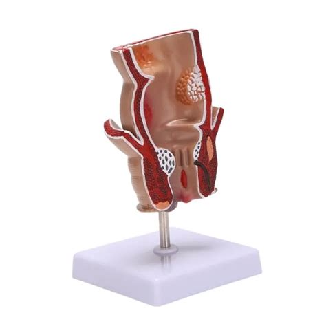 Anatomy Model Human Rectal Hemorrhoid Lesion Model Hemorrhoid