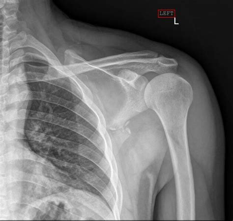 Comminuted Scapular Fracture