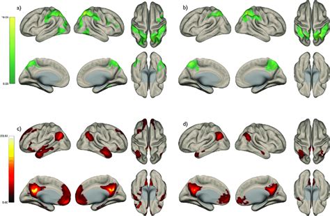 Dorsal Attention Network In A Healthy Controls And B Pca Patients