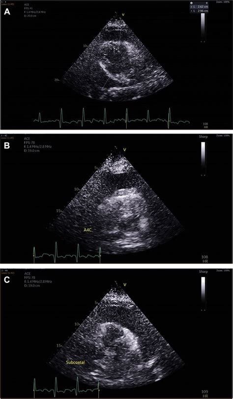 Bedside Echocardiogram Images Were Obtained Which Were Suboptimal Due