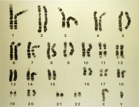 Heterozygous Vs Homozygous Differences