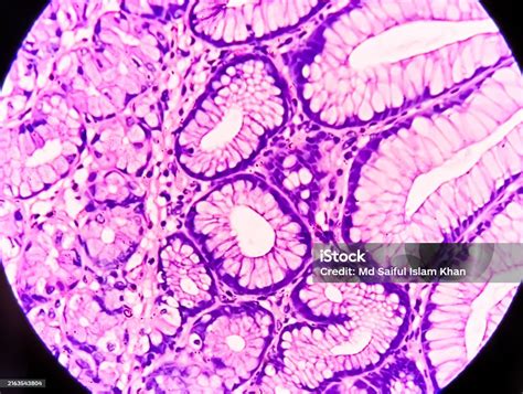 Photomicrograph Of Stomach Biopsy Showing Hyperplastic Polyp Stock Photomicrograph Of Stomach Biopsy Showing Hyperplastic Polyp Stock