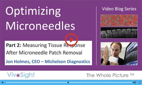 Optimization Of Microneedle Array Patches Maps Part 1 Vivosight