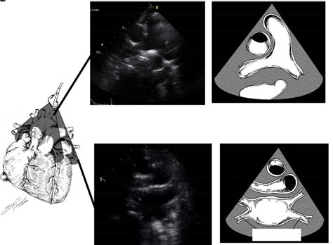 Echo Pediatric Suprasternal Long Diagram Quizlet