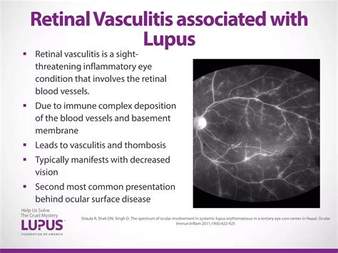 Lupus And The Eye Pdf