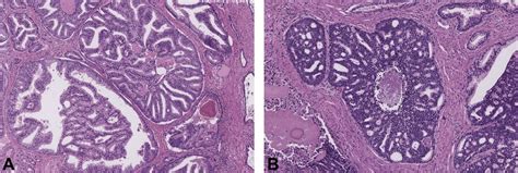 Gleason Grade 5 Prostate Cancer Sub Patterns And Prognosis Pathology