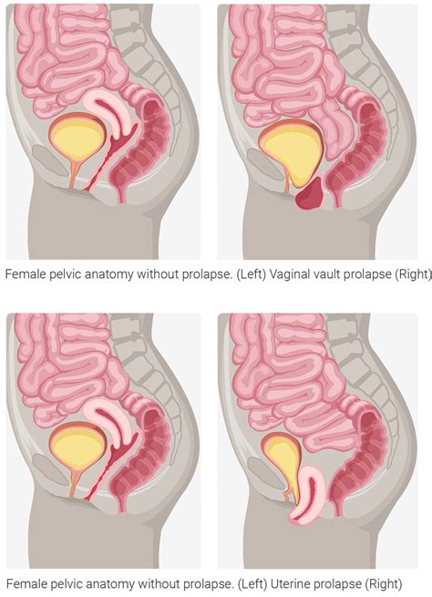 Prolapsed Vaginal Wall
