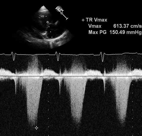 The Gerbode Defect A Ventriculo Atrial Defect Ctsnet