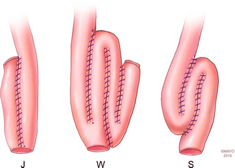 J W And S Pouch Anatomical Configurations Used With Permission Of