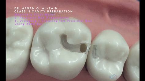 Class I Cavity Preparation For Amalgam Mandibular Molar 47 54 Off