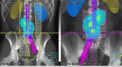 Male Pelvis Localization And Treatment Procedures In Radiation Therapy