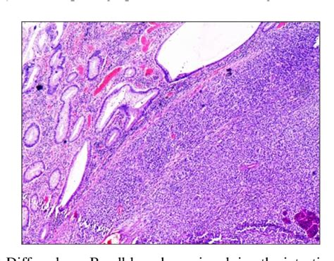 Figure 1 From Telescoping Intestines Intussusception In Adults