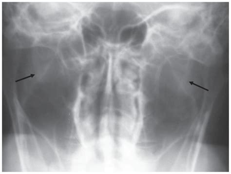 Towne Radiograph Shows Bilateral Elongated Styloid Processes Right 29