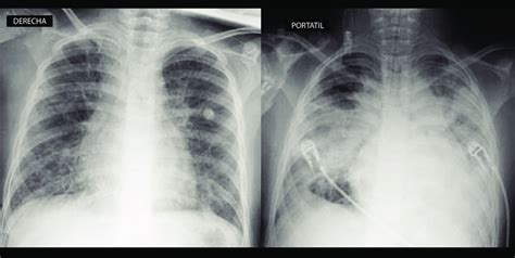 Chest X Rays Left On Admission With Interstitial Infiltrates And Chest X Rays Left On Admission With Interstitial Infiltrates And