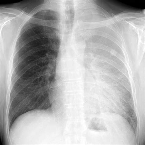 Left Upper Lobe Pneumonia [1 Of 2] Radiology Pneumonia Radiography