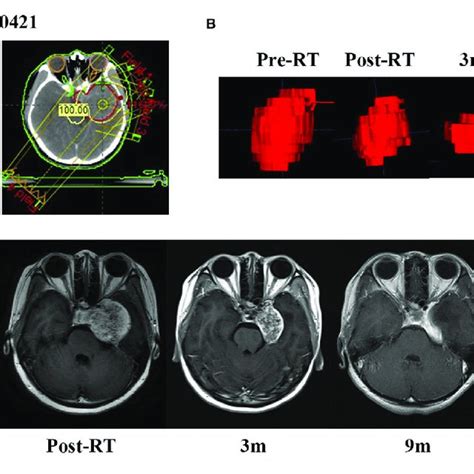 A Mass Occupying The Left Cavernous Sinus Of A 24 Year Old Woman Download Scientific Diagram