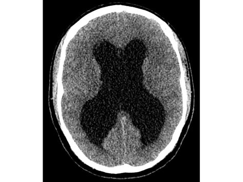 Beyond The Bleed Acute Hydrocephalus As A Cause Of Headache Jems Ems Emergency Medical