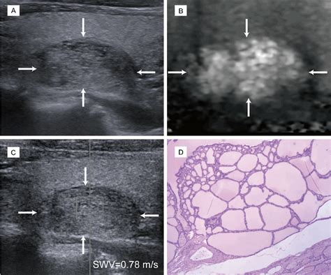 Images In A 56 Year Old Woman With Nodular Goiter Without Highly