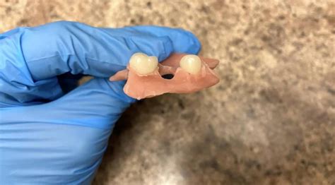How Can I Make My Own Dentures At Home