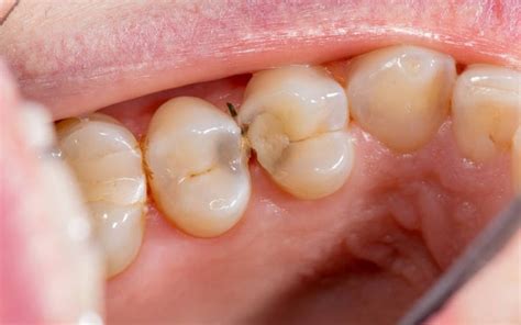 What Does A Cavity Look Like On An X Ray By Wicker Park Dental Group