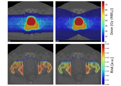 양성자 대 탄소 이온 치료 모델이 21차 암 위험을 비교합니다 Plato Aistream Vxnumx