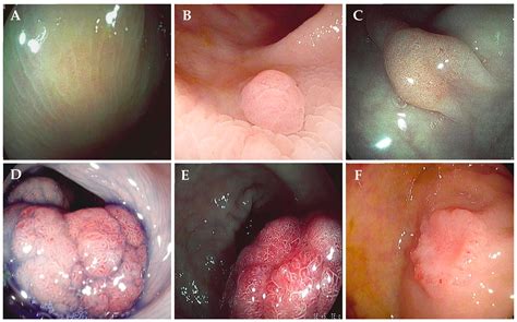 Reliability Of Kudos Glandular Pit Pattern In Predicting Colorectal Lesion Histology At Routine