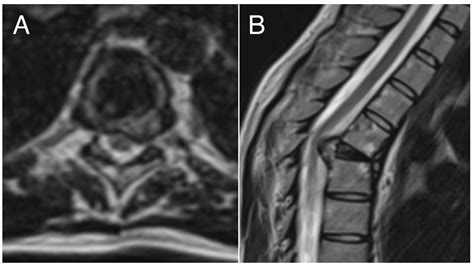 Epithelioid Hemangioma Of The Spine A Case Series And Treatment Flow