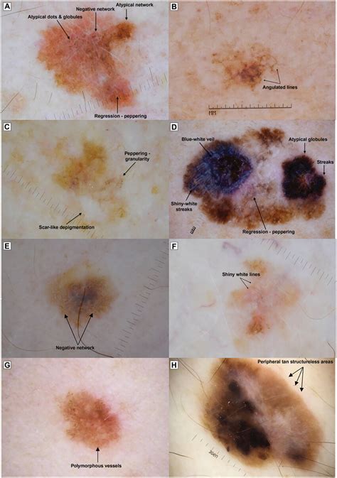 Clinical And Dermoscopic Morphology In Diagnosis Of M
