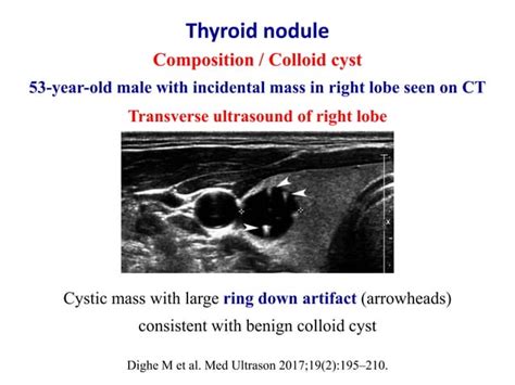Ultrasound Of Thyroid Nodules Pptx Thyroid Disorders Endocrine
