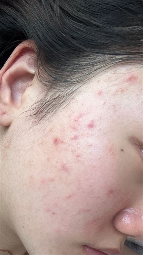 여드름 종류 지식in