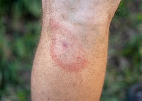 Tekenbeet Herkennen Pazzox Online Apotheek Zonder Zorgen