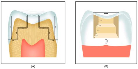Class Ii Cavity Preparation A Crown Sectioned Lengthwise Download Scientific Diagram