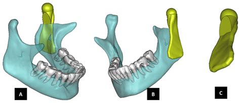 Design And Finite Element Analysis Of Patient Specific Total Temporomandibular Joint Implants