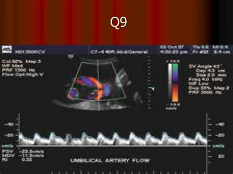 Ppt Severe Variable Deceleration With Overshoot However Variability Is Preserved Powerpoint