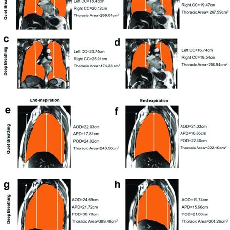 Comparison Of Pulmonary Function Mip Mep Measurements Between Download Scientific Diagram
