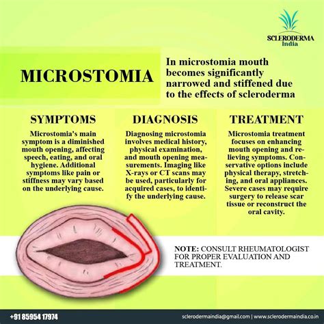 Scleroderma India On Linkedin Microstomia Scleroderma Scleroderma India On Linkedin Microstomia Scleroderma